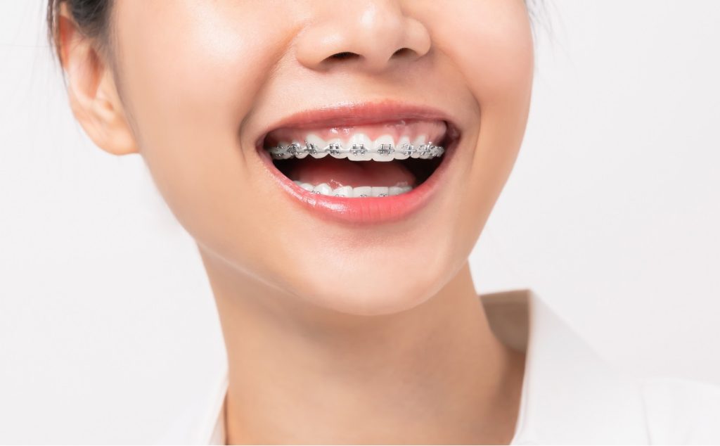 Adult Orthodontics • Capa Orthodontic and Dental Treatment Center